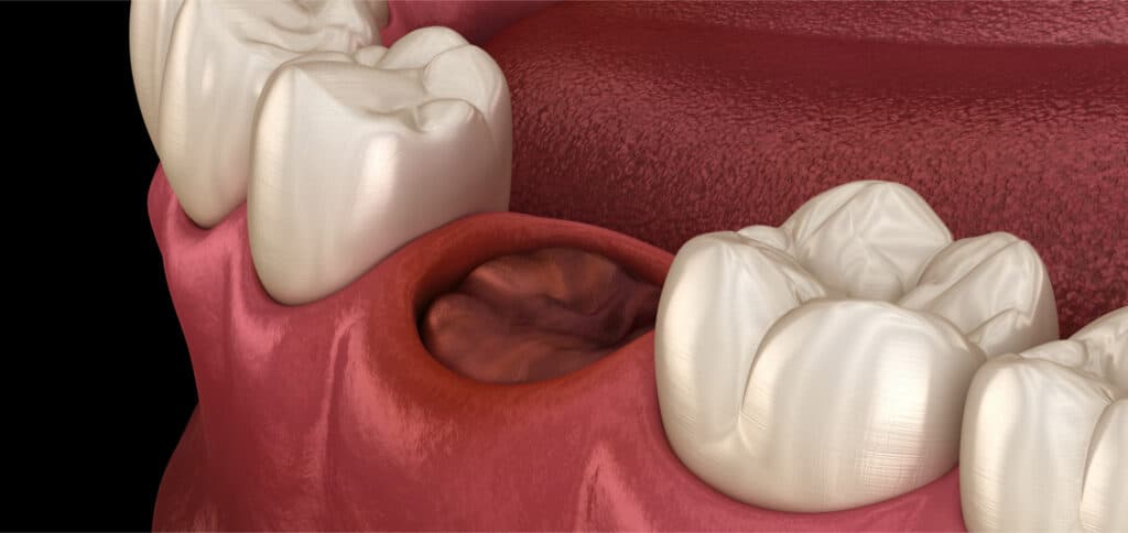 Alveolitis: causas, tipos y tratamientos - Udemax